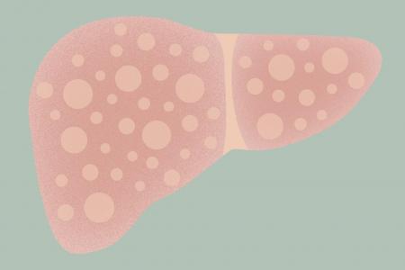 Stéatose hépatique : une maladie sournoise, mais réversible | Pulsations